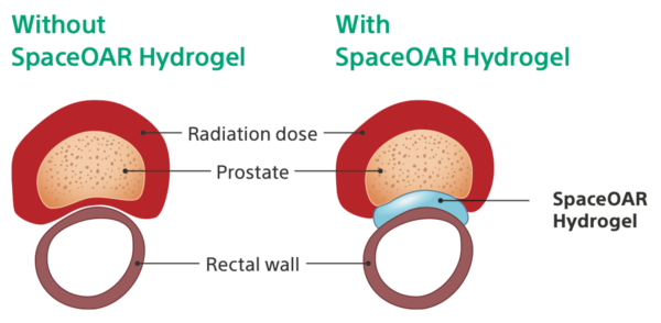 SpaceOar - East Valley Urology Center of Arizona