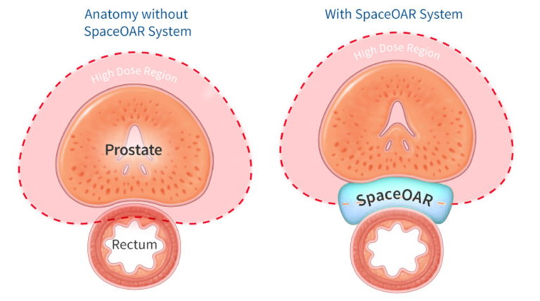 SpaceOar - East Valley Urology Center of Arizona