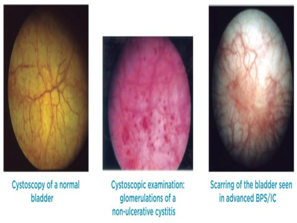 INTERSTITIAL CYSTITIS - East Valley Urology Center of Arizona